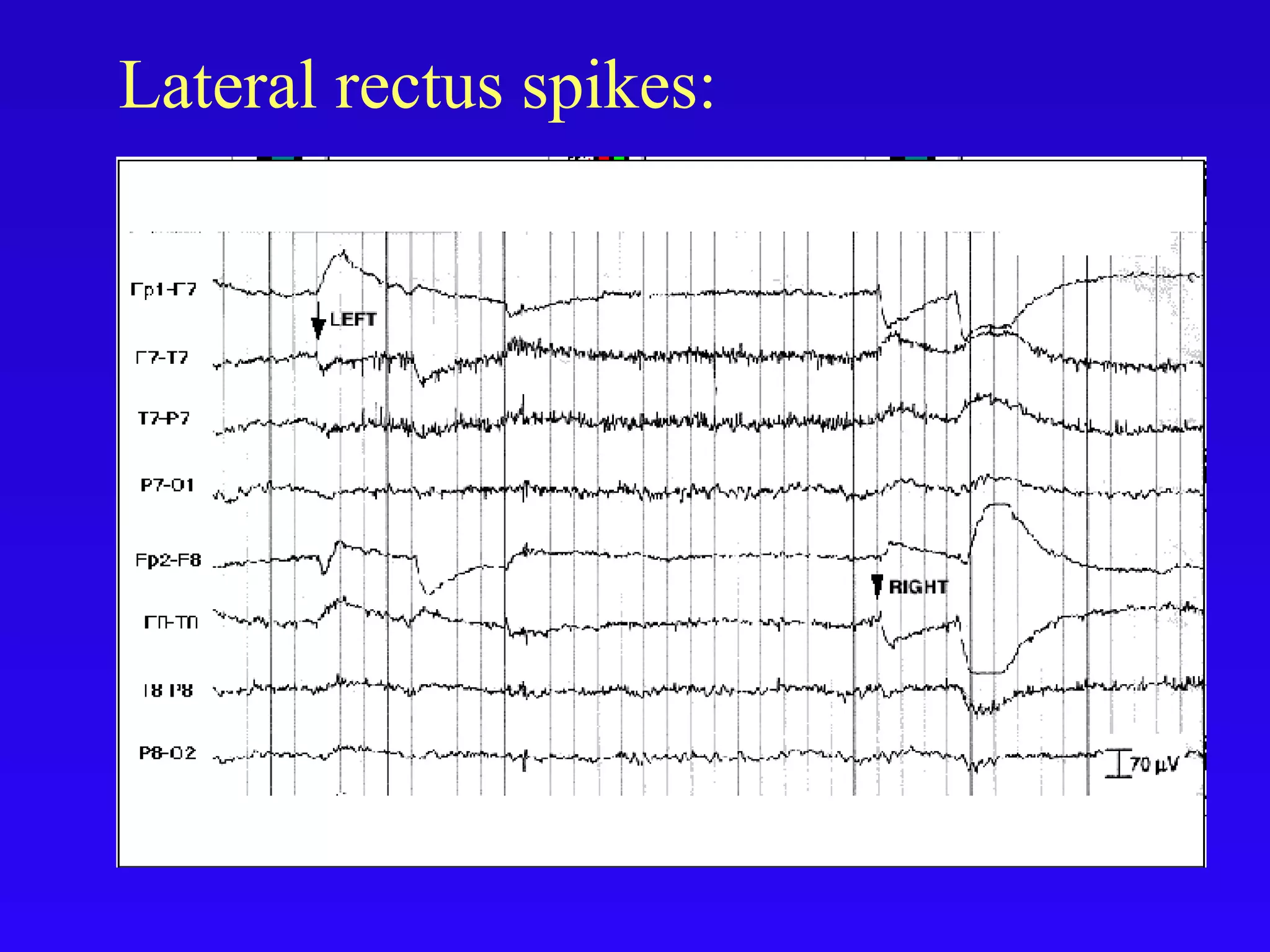 Artifacts in eeg final | PPT