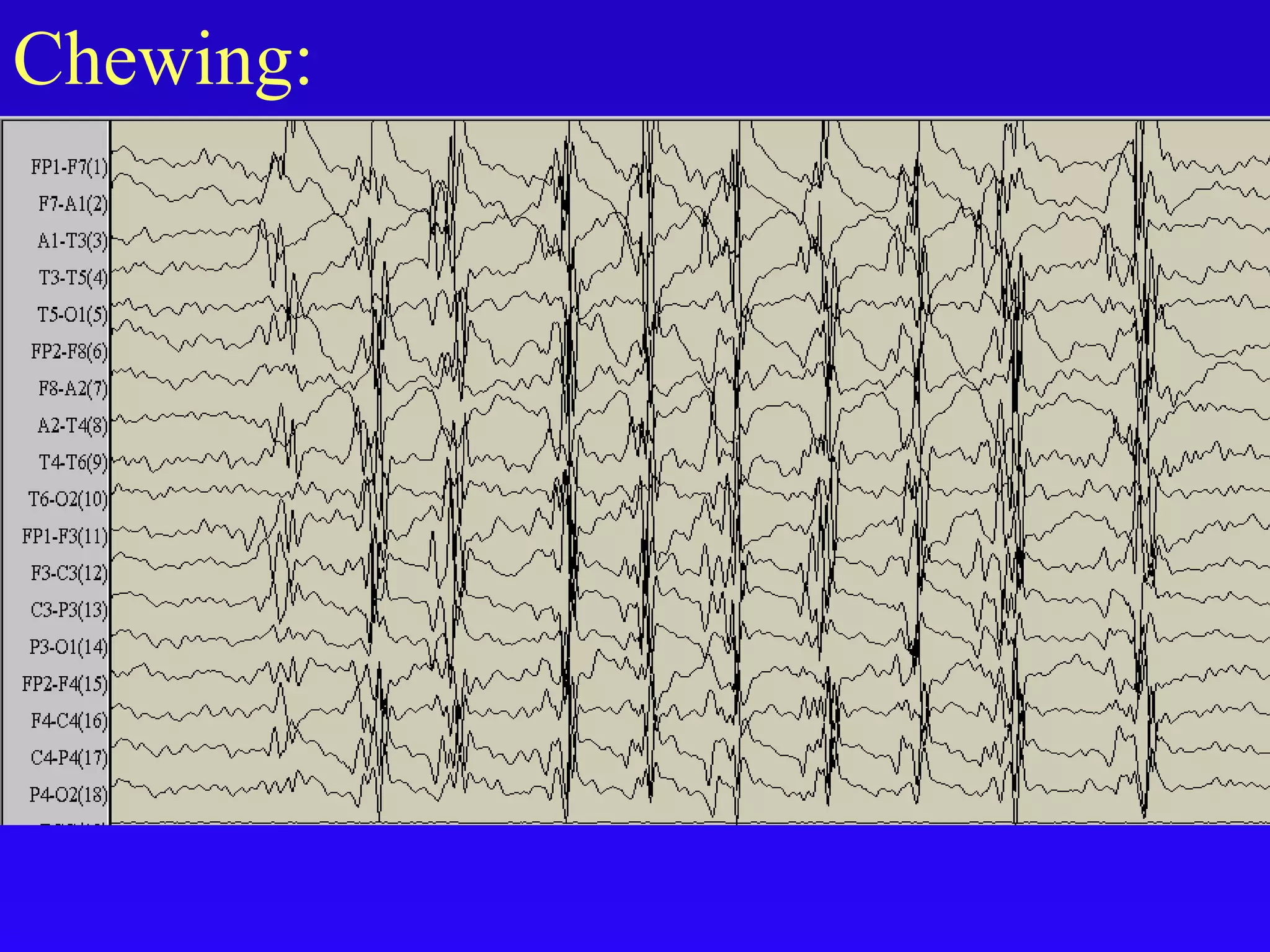 Artifacts in eeg final | PPT