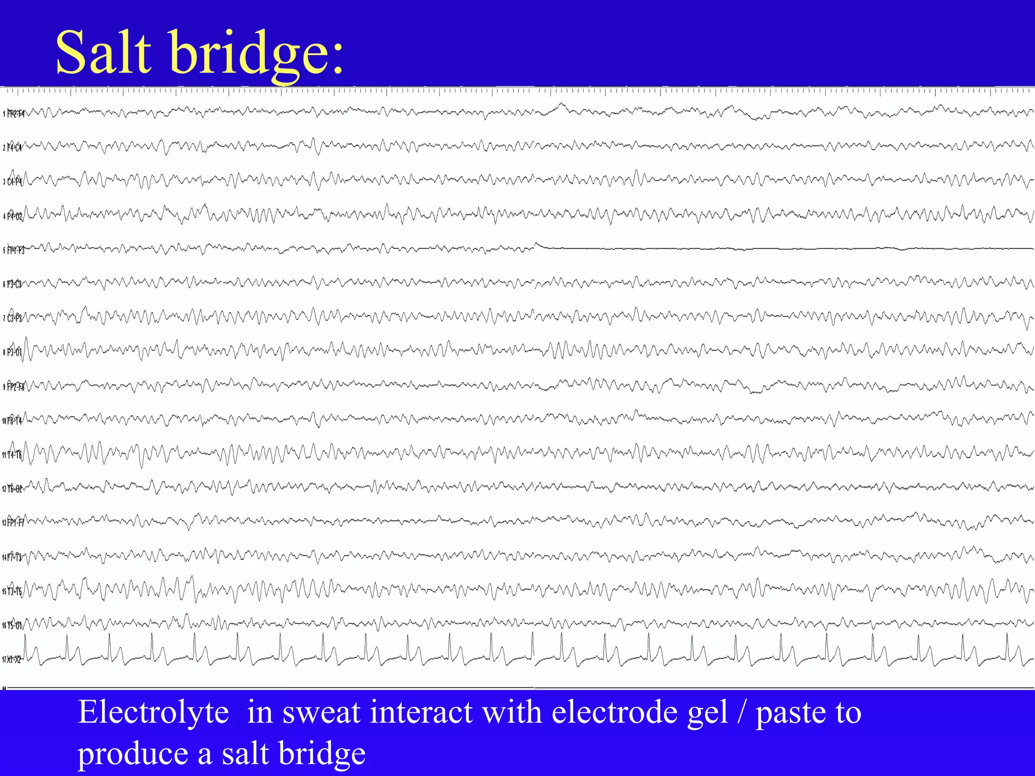 Artifacts in eeg final | PPT