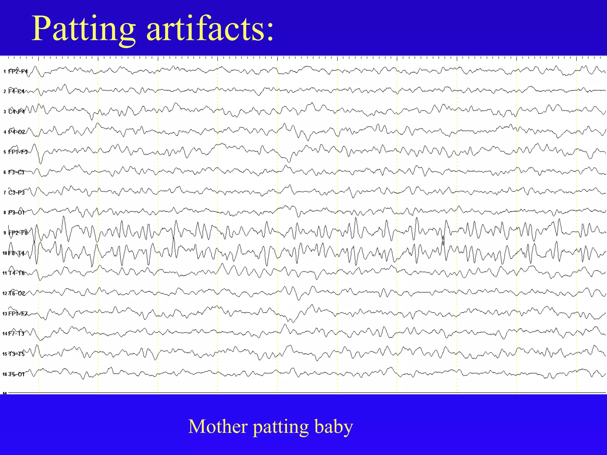 Artifacts in eeg final | PPT | Brain and Nervous System Disorders | Diseases and Conditions