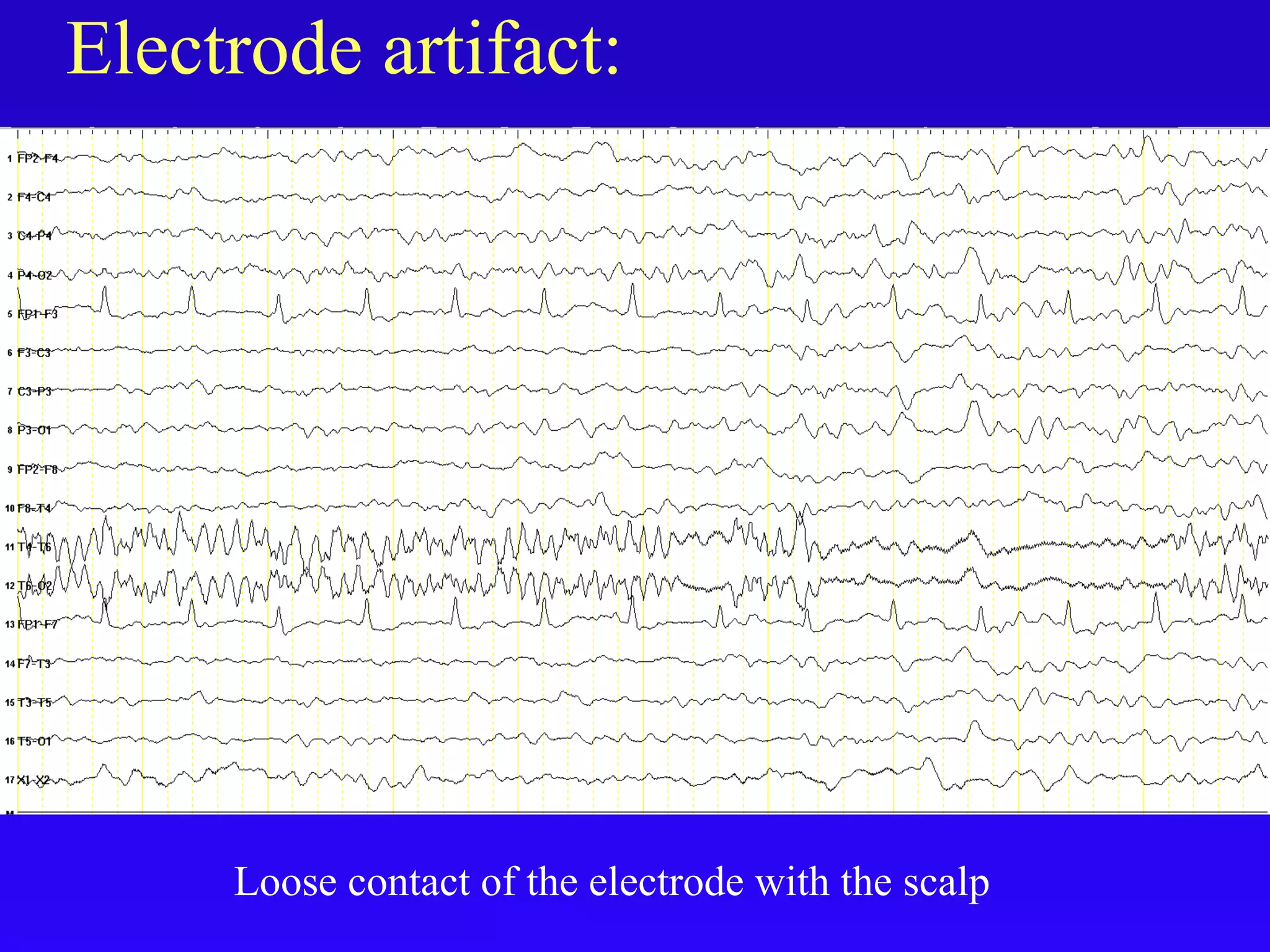Artifacts in eeg final | PPT | Brain and Nervous System Disorders | Diseases and Conditions