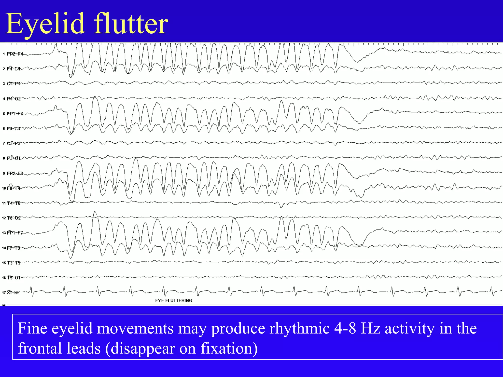 Artifacts in eeg final | PPT