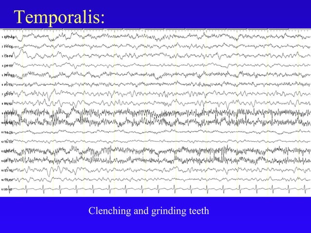 Artifacts in eeg final | PPT | Brain and Nervous System Disorders ...