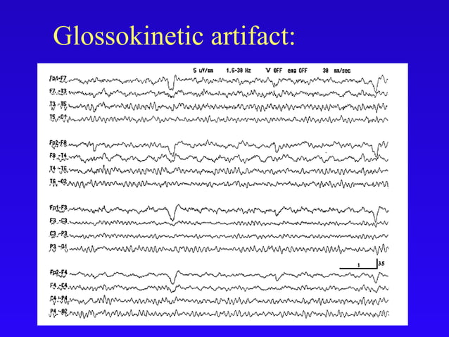 Artifacts in eeg final | PPT | Brain and Nervous System Disorders ...