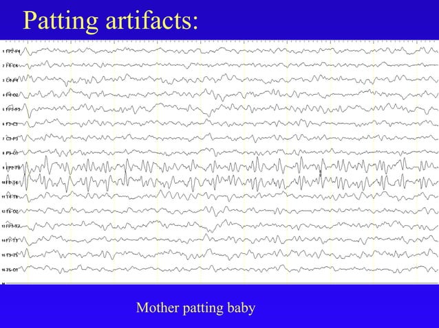 Artifacts in eeg final | PPT | Brain and Nervous System Disorders ...