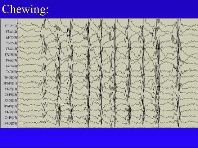 Eeg Spikes