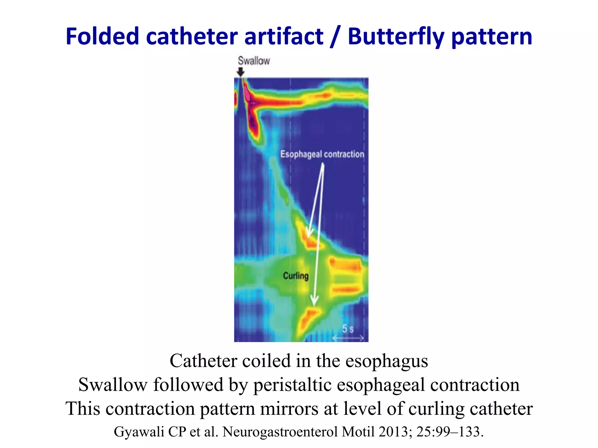 Artifacts in esophageal high resolution manometry | PPTX