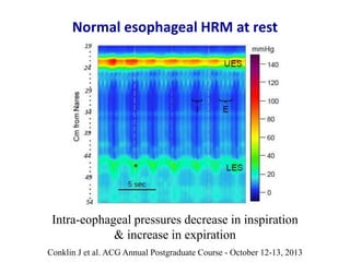 Artifacts in esophageal high resolution manometry | PPTX