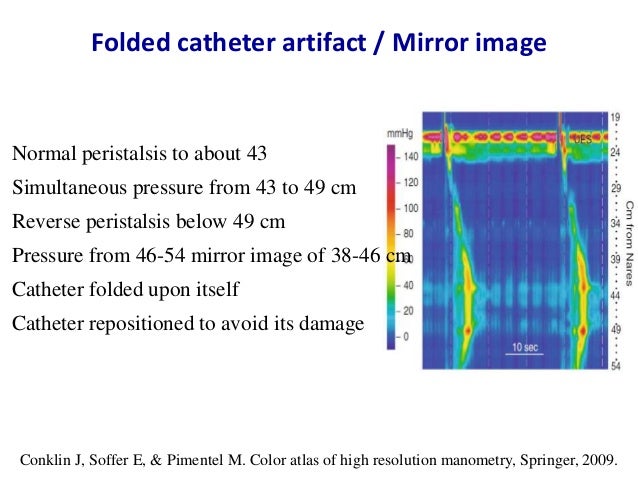 Artifacts in esophageal high resolution manometry