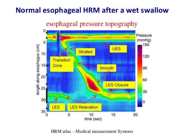 Artifacts in esophageal high resolution manometry