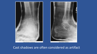 ARTIFACTS IN GENERAL radiography for radiodept.pptx