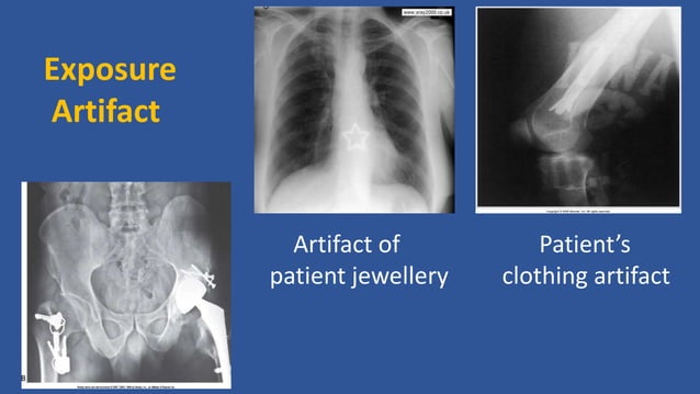 ARTIFACTS IN GENERAL radiography for radiodept.pptx