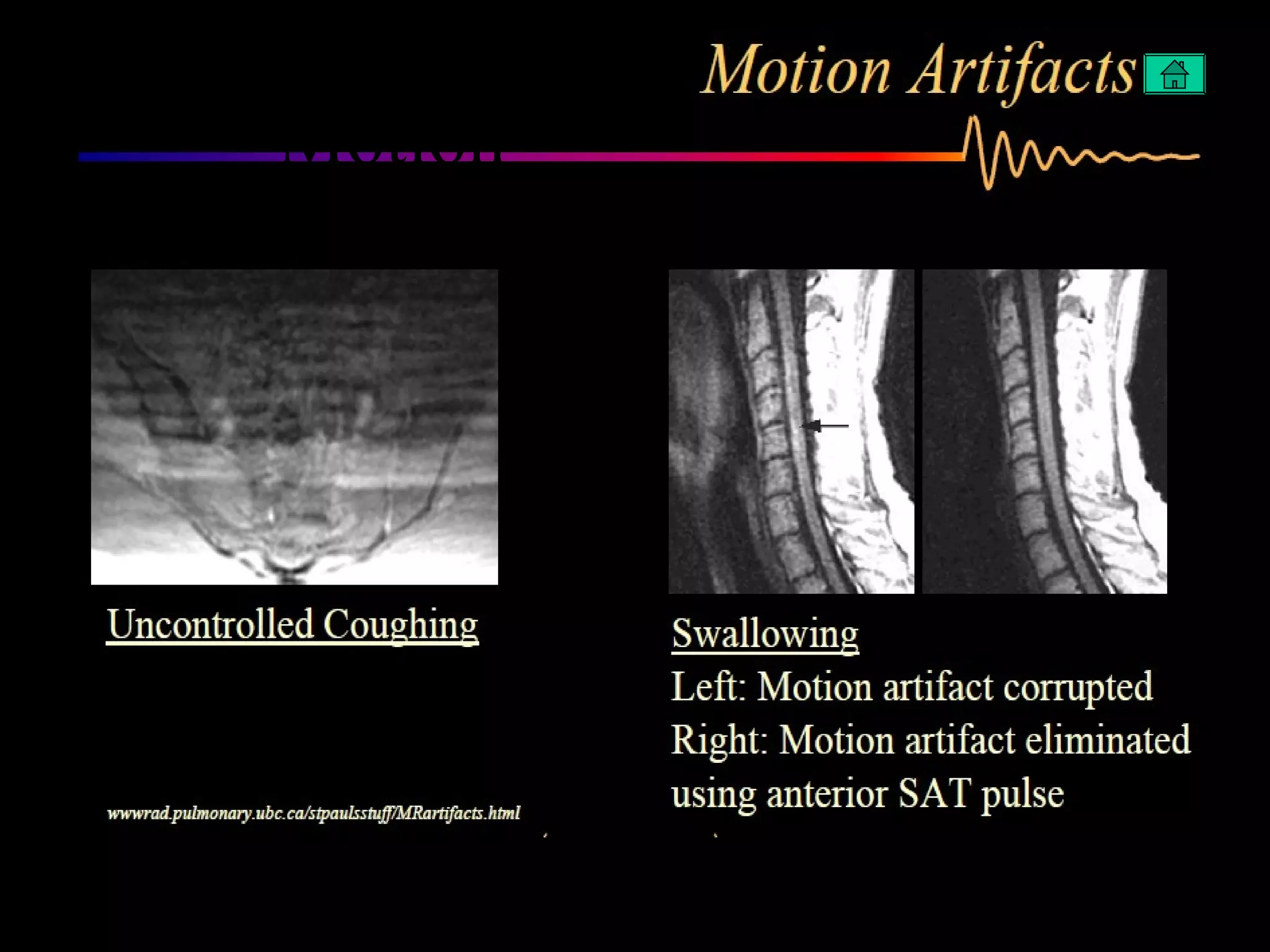 Artifacts in MRI | PPT