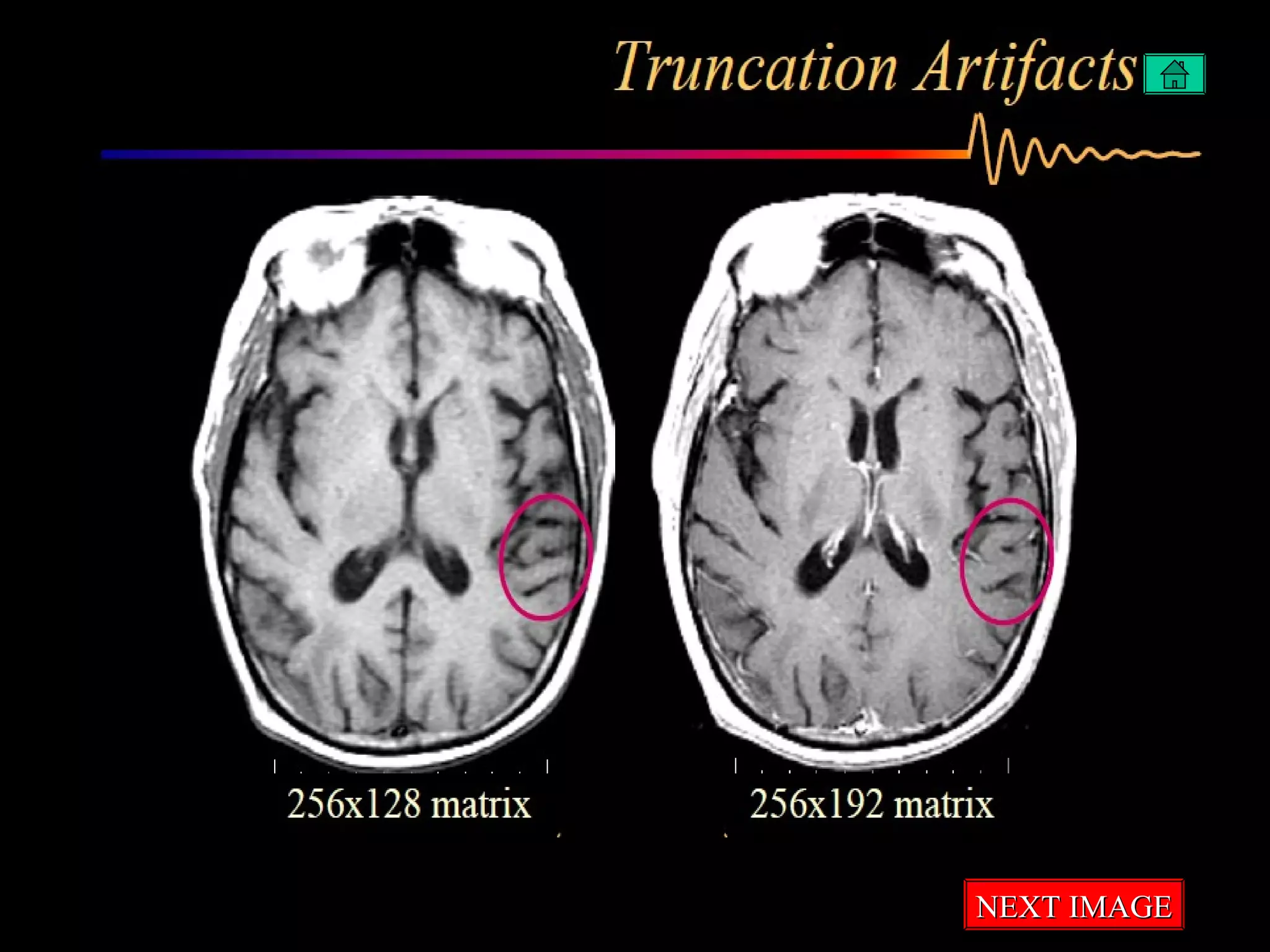 Artifacts in MRI | PPT