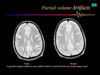 Artifacts in MRI | PPT