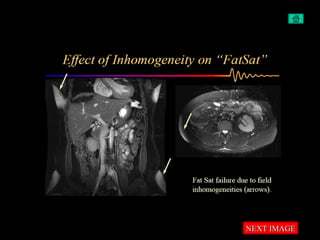 Artifacts in MRI | PPT