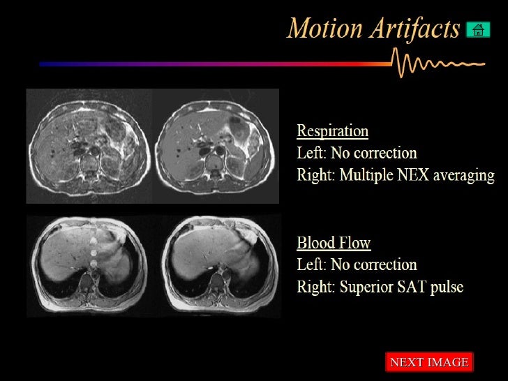 Artifacts in MRI