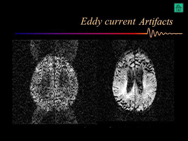 Artifacts in MRI