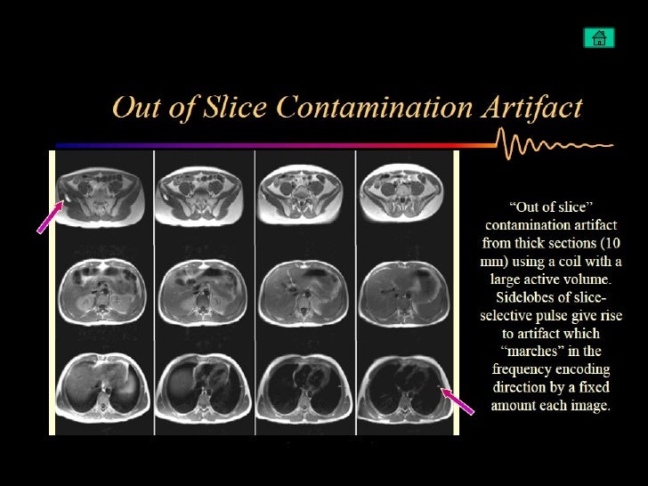 Artifacts in MRI