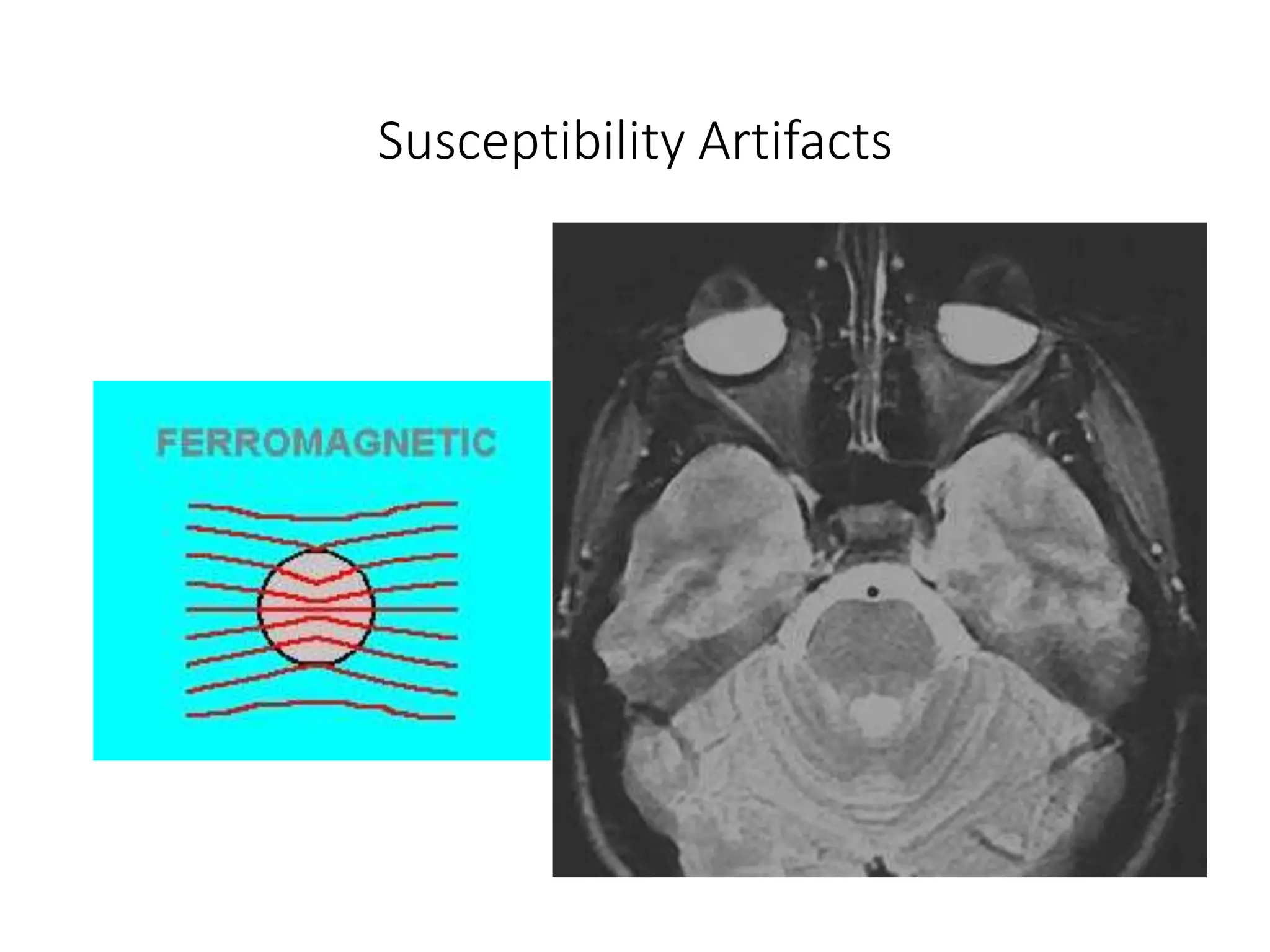 Mri Artifacts Introduction Classification Types Ppt