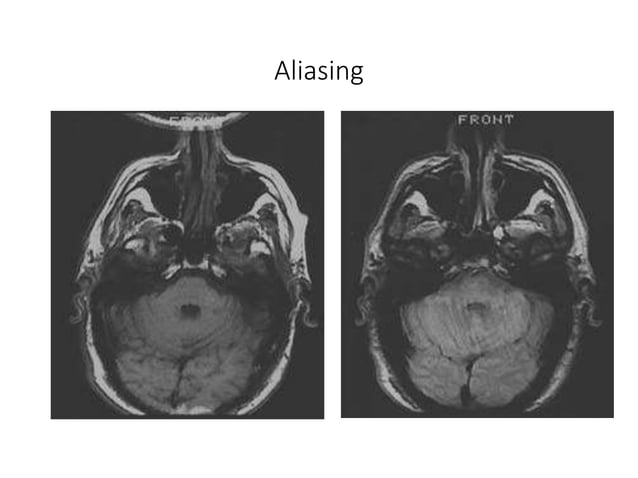 MRI Artifacts (introduction, classification, types) | PPT