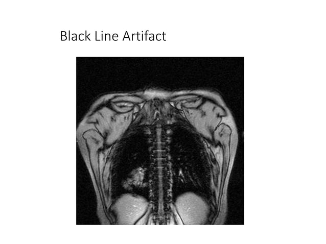 MRI Artifacts (introduction, classification, types) | PPT