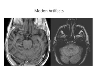 MRI Artifacts (introduction, classification, types) | PPTX