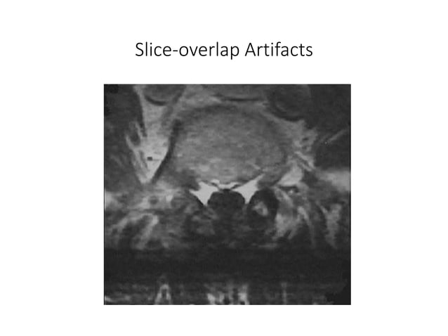 MRI Artifacts (introduction, classification, types) | PPT