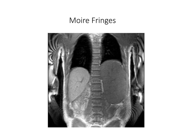 MRI Artifacts (introduction, classification, types) | PPT