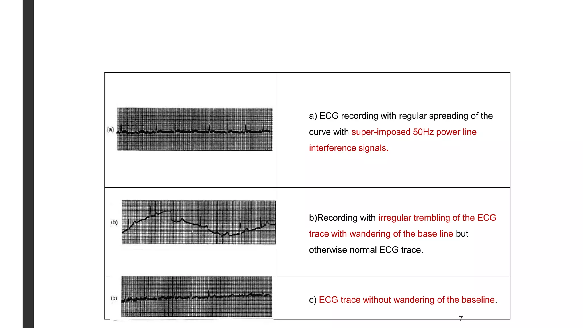 ARTIFACTS ON ECG RECORDING | PDF