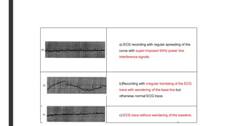 ARTIFACTS ON ECG RECORDING | PDF
