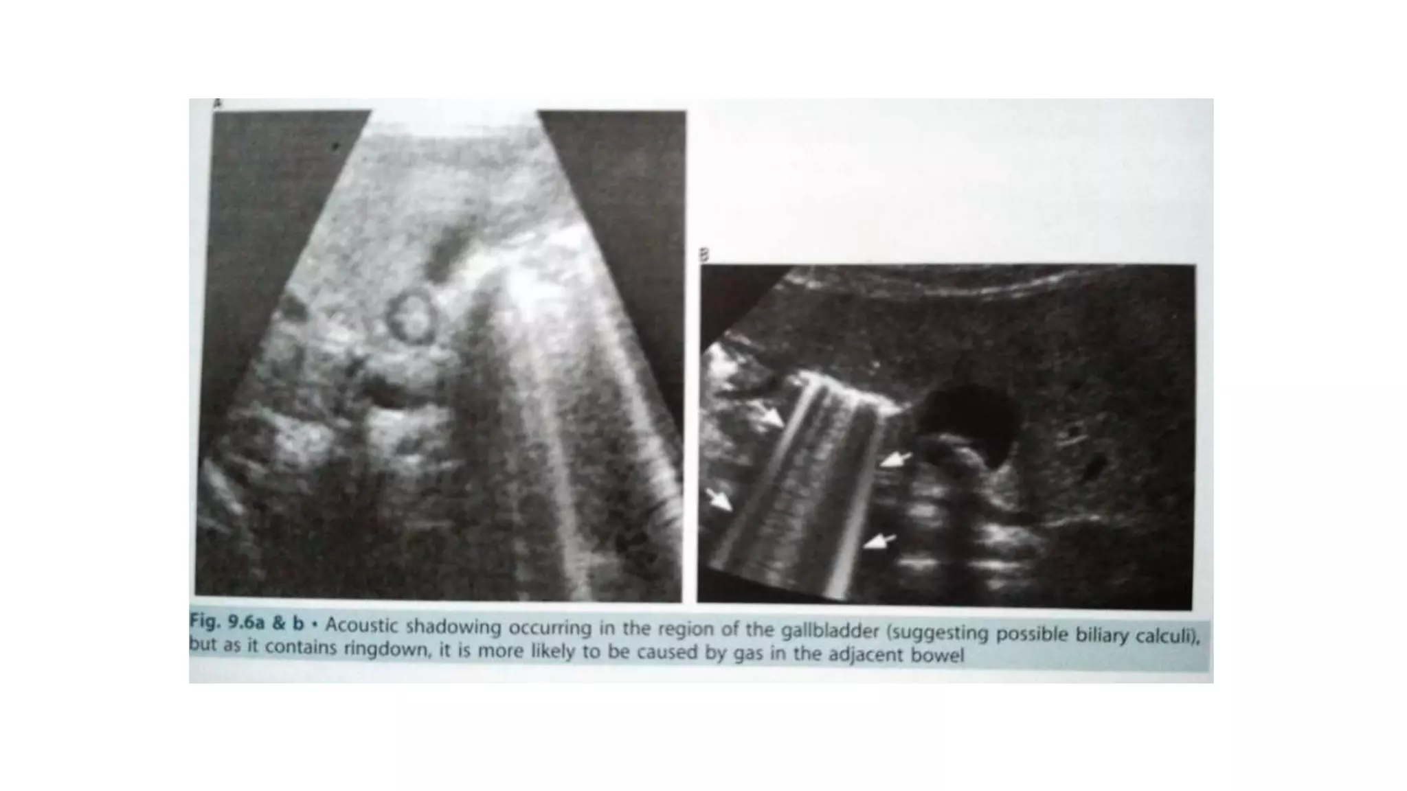 Artifacts usg, ct, mri radiology ppt,pdf pk | PPTX