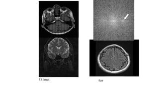 Artifacts usg, ct, mri radiology ppt,pdf pk | PPTX