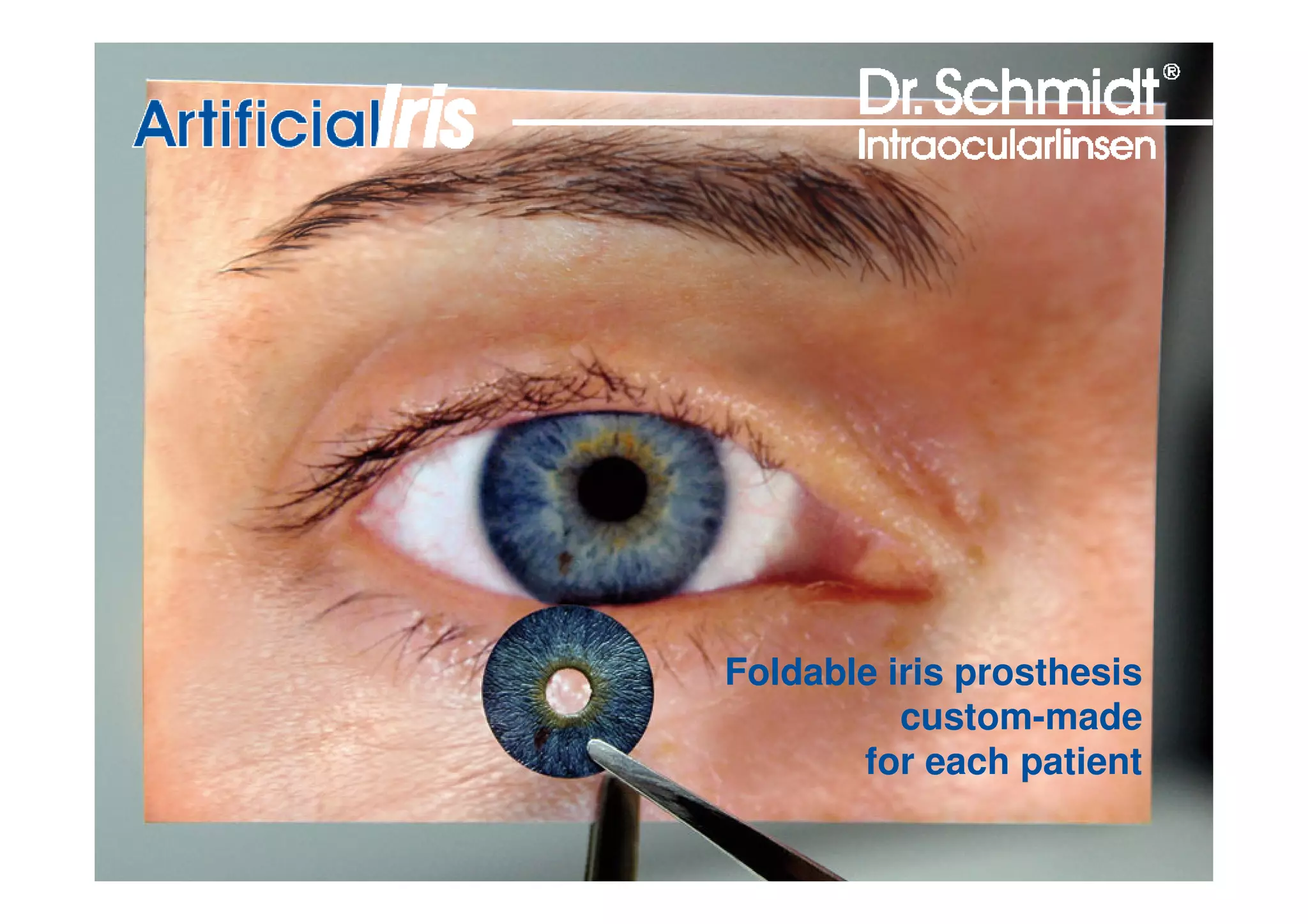 Artifical iris photo-and-print-out_4-2010-1 | PDF