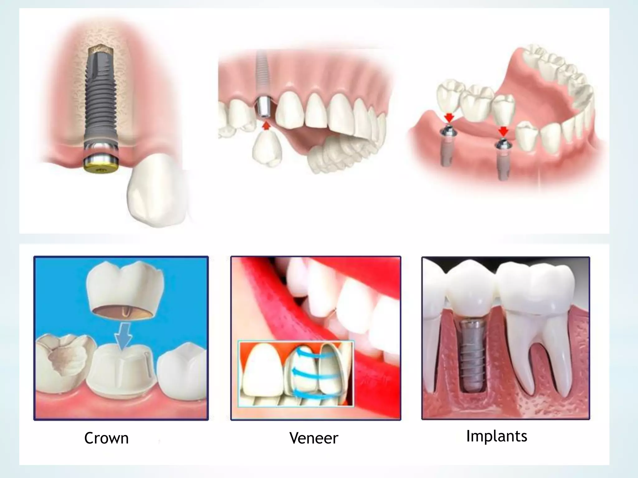 Artificial crowns. Temporary crowns..pdf