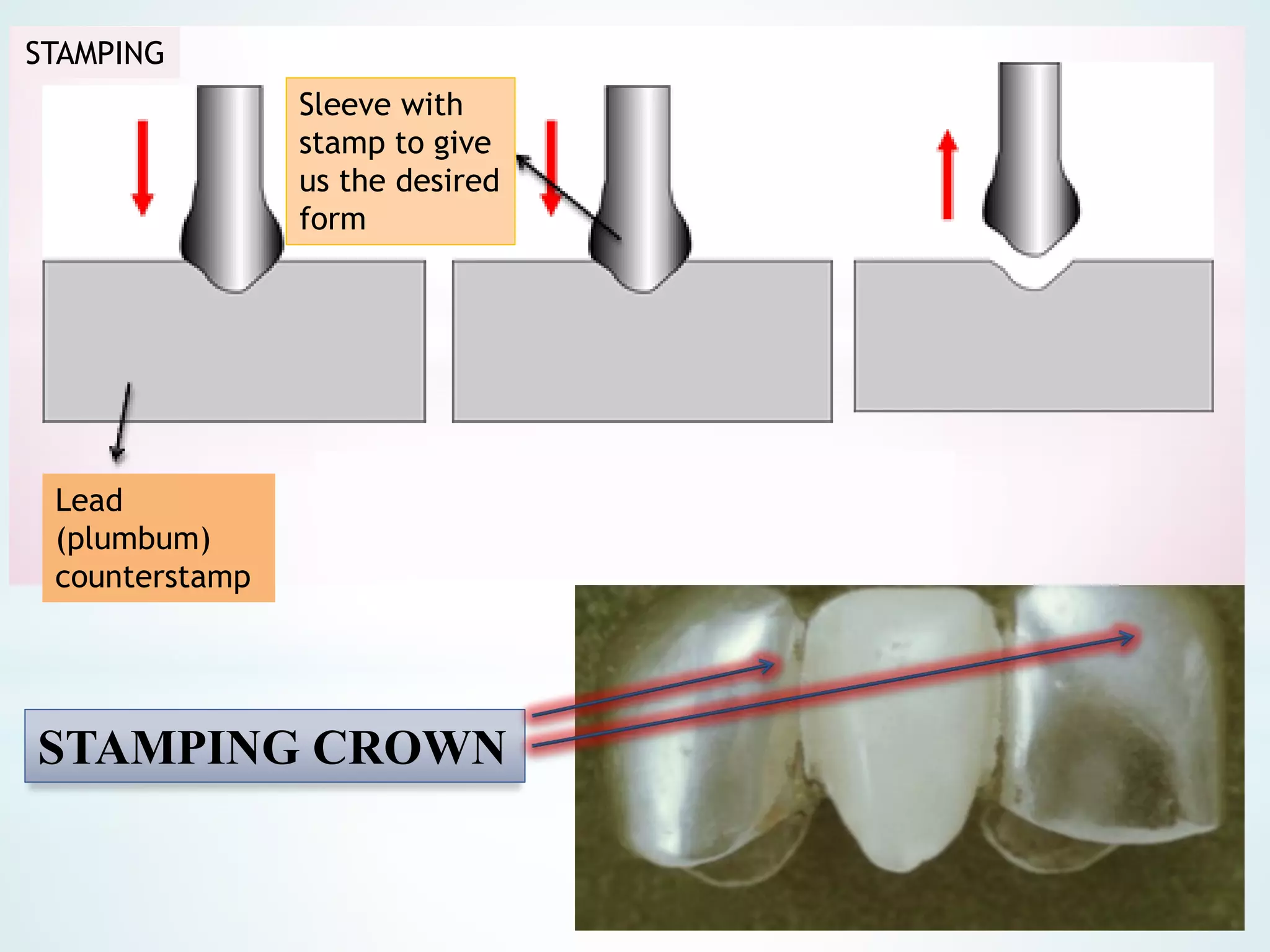 Artificial crowns. Temporary crowns..pdf