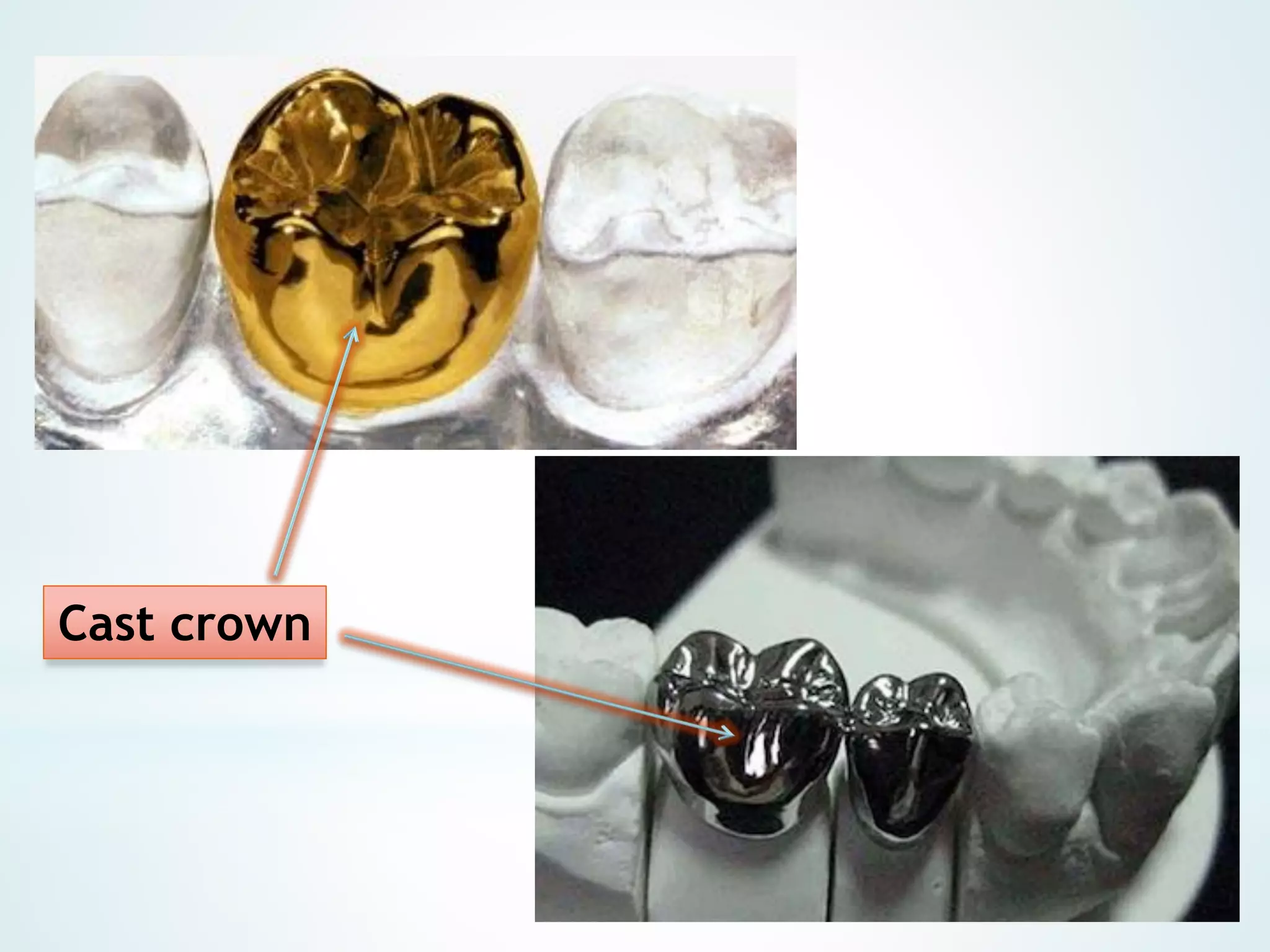 Artificial crowns. Temporary crowns..pdf