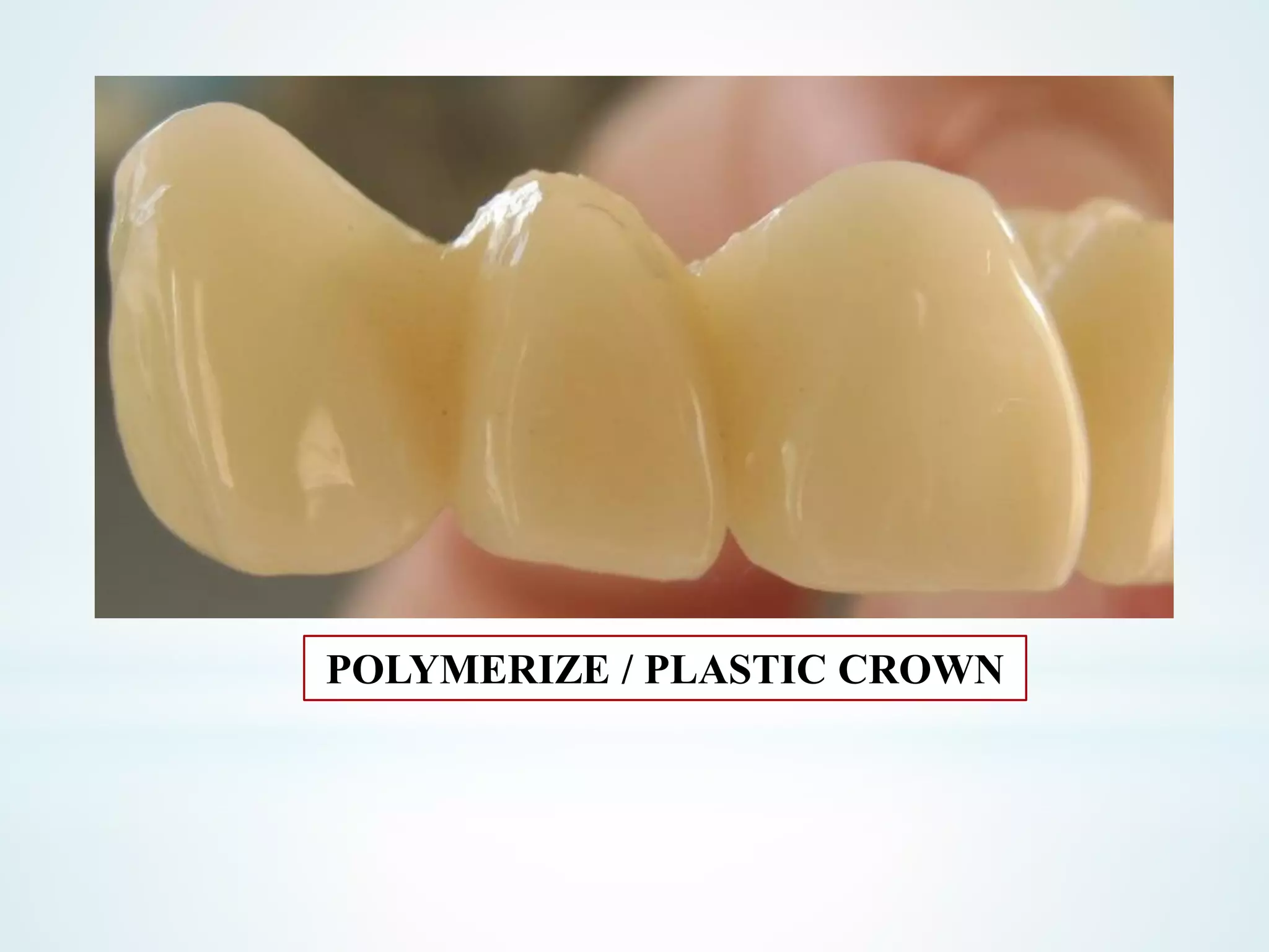 Artificial crowns. Temporary crowns..pdf