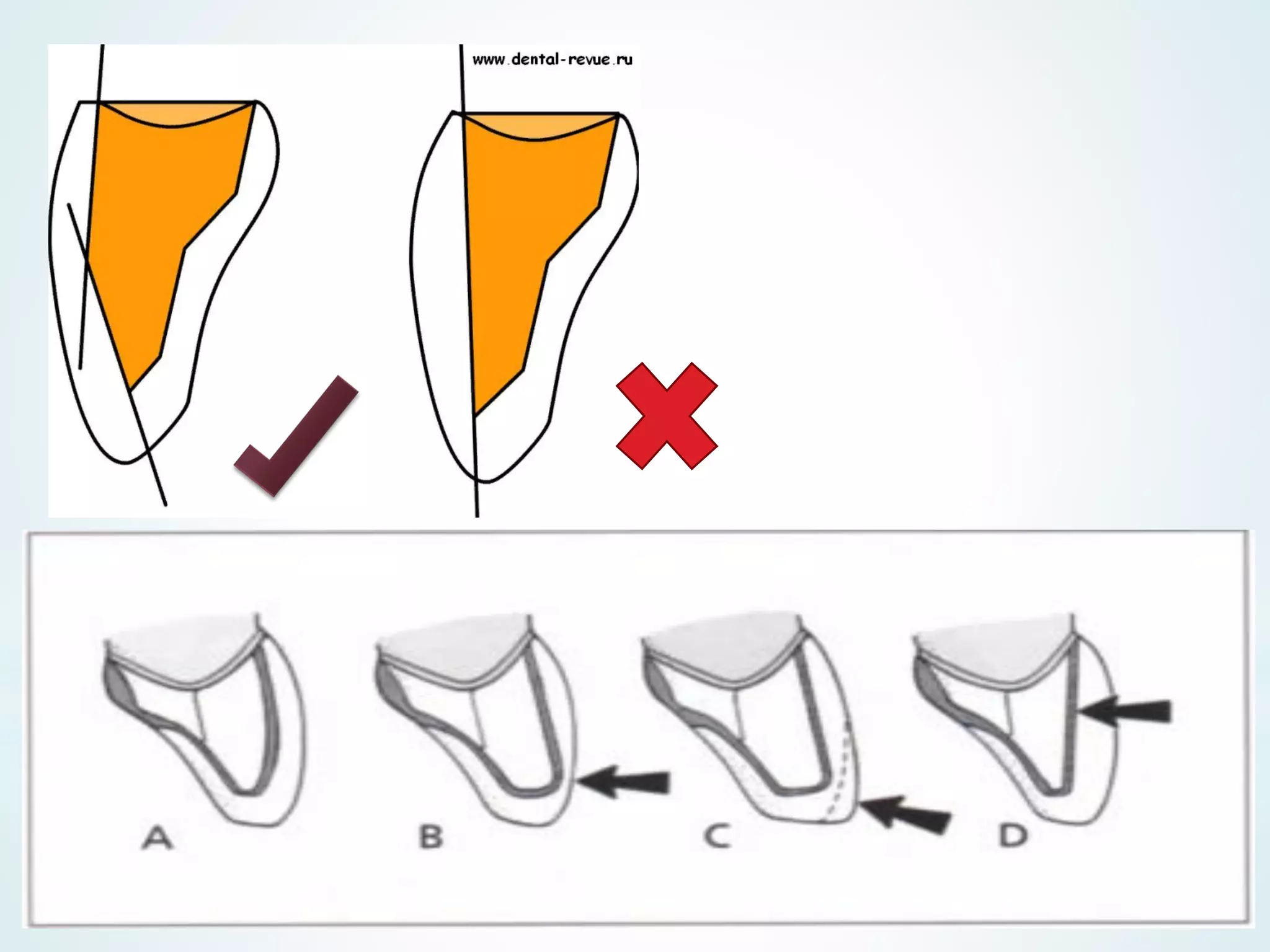 Artificial crowns. Temporary crowns..pdf