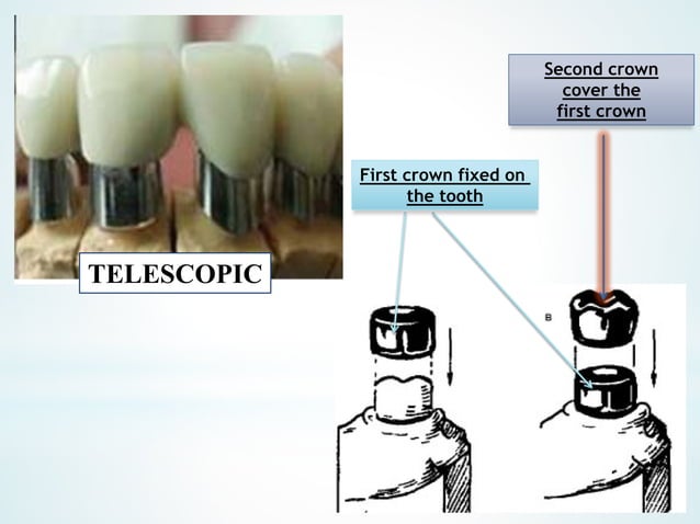 Artificial crowns. Temporary crowns..pdf
