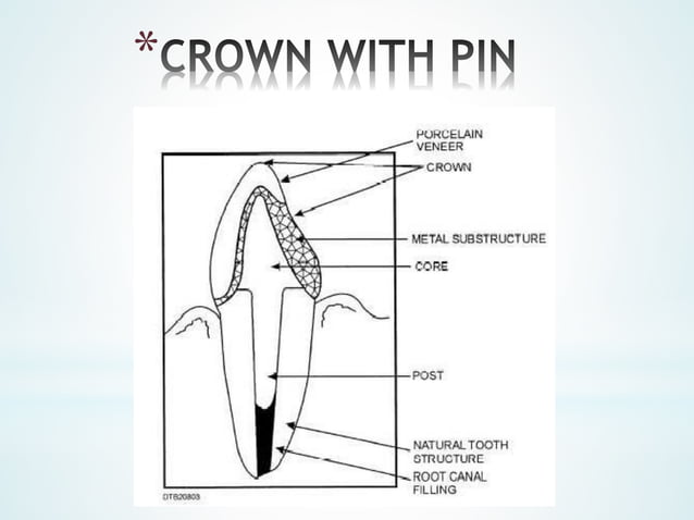 Artificial crowns. Temporary crowns..pdf