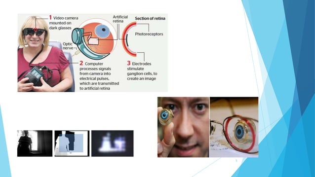 Bionic eye | PPTX