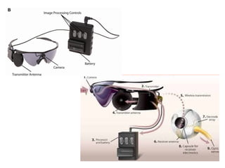 artificial eye ( bionic eye, MARC, epiretinal prosthesis, etc.).pptx