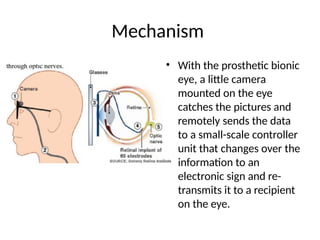 artificial eye ( bionic eye, MARC, epiretinal prosthesis, etc.).pptx