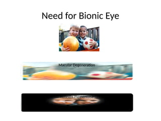 artificial eye ( bionic eye, MARC, epiretinal prosthesis, etc.).pptx