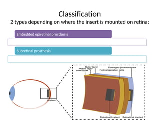 artificial eye ( bionic eye, MARC, epiretinal prosthesis, etc.).pptx