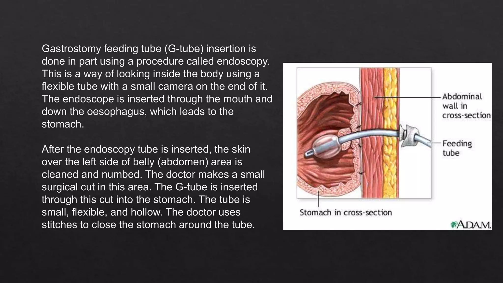 Artificial feeding of the patient | PPTX