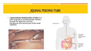 Artificial feeding of the patient | PPTX