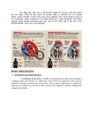 Artificial heart | DOC