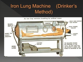 Iron Lung Diagram